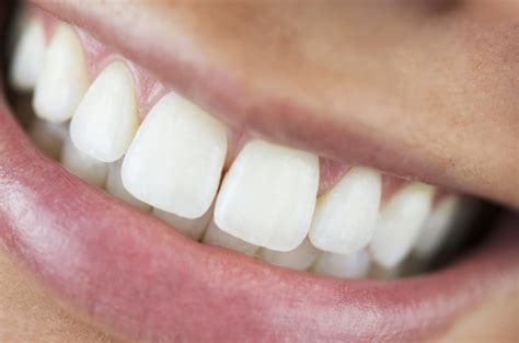 Overbite Vs Underbite The Similarities And Differences