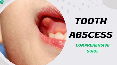 Understanding Tooth Abscess A Comprehensive Guide 2024
