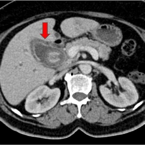 An Abdominal Ct Scan Demonstrates Thickening Of The Gallbladder Wall Download Scientific Diagram An Abdominal Ct Scan Demonstrates Thickening Of The Gallbladder Wall Download Scientific Diagram