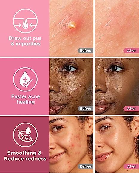 Litbear Acne Patch Black And Pink Star Shaped 112 Patches 14mm And 10mm