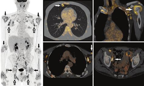 Maximum Intensity Projection Demonstrated Intense Tracer Uptake In Download Scientific Diagram