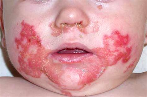 Mild Acrodermatitis Enteropathica