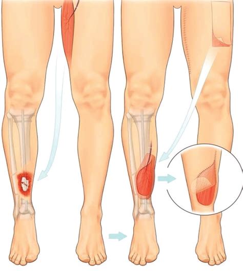 Open Fractures University Hospitals Sussex Nhs Foundation Trust