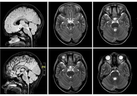 Paediatric Rhombencephalitis Presenting With Bradycardia A Good