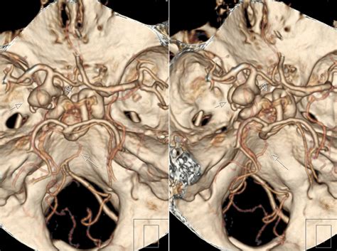 Aneurysm Of Persistent Trigeminal Artery