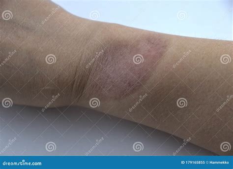 Scald Or Steam Burn Scar On Arm Stock Image Image Of Burn Injury