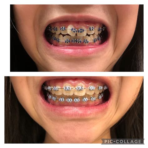 3 Months Braces Progress R Braces