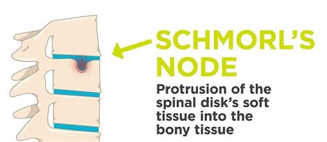 Schmorls Node What You Need To Know Mayfair Wellness Clinic