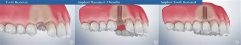 Implant Post Operative Guide Frederick Stange Dds And Associates