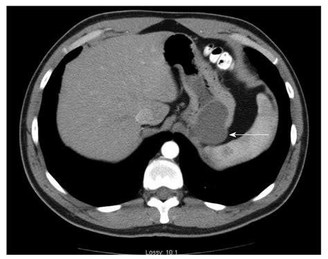 What Is A Foregut Duplication Cyst At Jack Black Blog