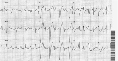 Dr Smith S ECG Blog A Southeast Asian With Tachycardia And Hypotension After Taking A