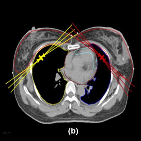 Beam Arrangements And Isocenter Positions For A Single Fixed‐jaw Download Scientific Diagram