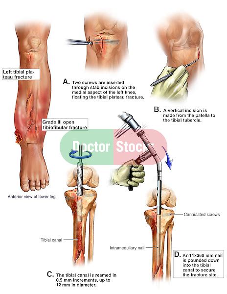 Intramedullary Rod Tibia