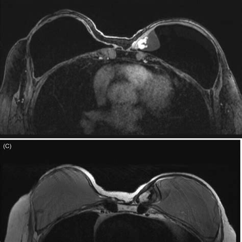 Left Breast Ultrasound Shows A Peripherally Hyperechoic Centrally