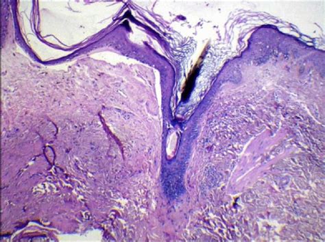 Representative Histopathology Of Extragenital Lichen Sclerosus Showing Download Scientific
