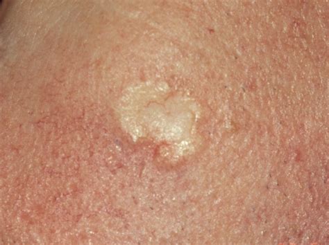 What Is Nodular And Infiltrating Basal Cell Carcinoma