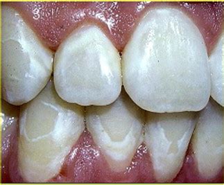 Do Orthodontic Braces Cause White Spots On Teeth Jorgensen