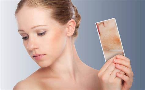 Transform Your Look Say Goodbye To Burn Scars On Face