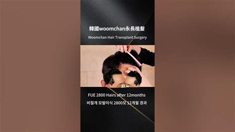 韓國專業植髮醫院，2800毛植髮效果，效果怎樣呢？ 韩国植发医院 Hairtransplantsurgery 永长植发 毛髮移植