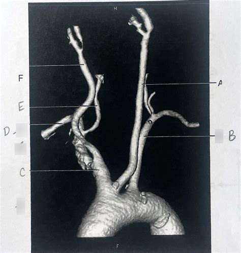 Ct Of Aortic Arch And Its Branches Diagram Quizlet