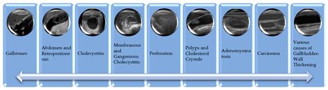 Detection Of Gallbladder Disease Types Using A Feature Engineering