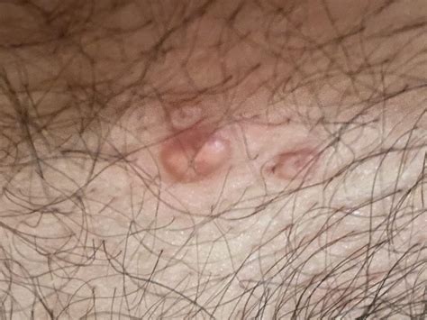 Bumps In Groin Area M R Medical