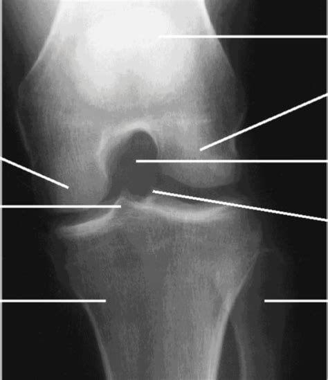 Pa Axial Intercondylar Fossa Diagram Quizlet
