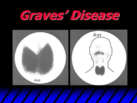 Ppt Thyroid Scan Powerpoint Presentation Free Download Id 437897