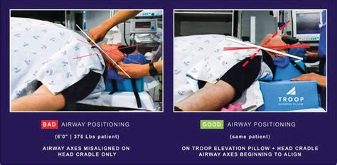 The Importance Of Proper Positioning For Airway Management For Obese