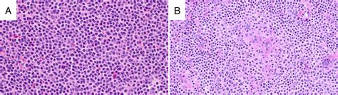 Nodal Marginal Zone Lymphoma The Histologic Appearance Of Nmzl Is
