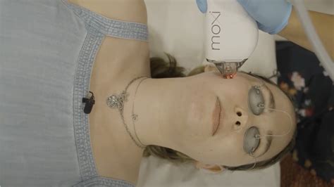 Tweak Of The Week Moxi By Sciton The Tweakments Guide