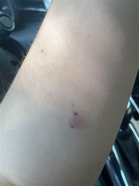 Ppd Test Cvs Surveys Hyatt