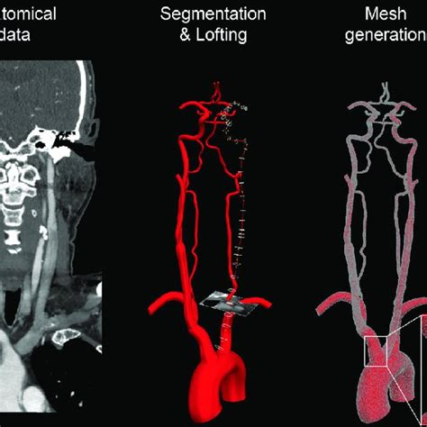 A Representative Case Of Cerebral Hyperperfusion A Pre Operative A Representative Case Of Cerebral Hyperperfusion A Pre Operative