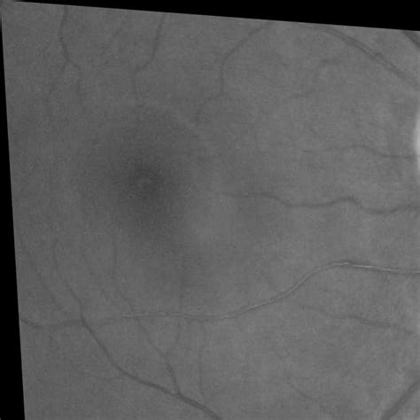 Retinal Disease Detection Object Detection Model V7 2024 06 20 156pm By Akhin