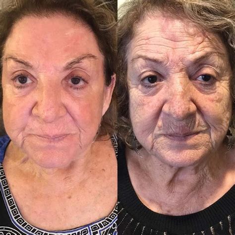 All About Phenol Peel Is It Worth It Risks And Results Phenol Peel