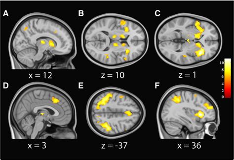 Significant Bold Activations For The Deviant N Standard Contrast From Download Scientific