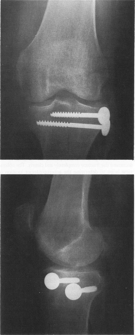 B Reduction And Internal Fixation Accomplished By Percutaneous Download Scientific Diagram