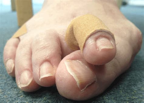 Transfer Metatarsalgia What Is Transfer Metatarsalgia