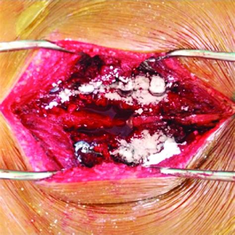 A Half Of Vancomycin Spread Throughout The Surgical Wound In Group 1