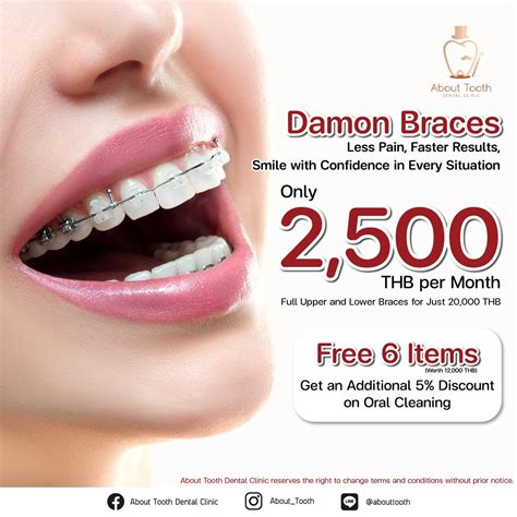 Damon Braces About Tooth Dental Clinic