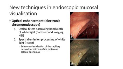 Colorectal Polyps Recognition Characterisation And Management Ppt