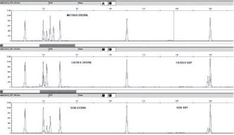 Alleles Corresponding To Sex Chromosomes Detected In Multiplex Qf Pcr