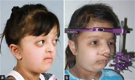 Facial Hypoplasia Yahoo Canada Image Search Results Facial