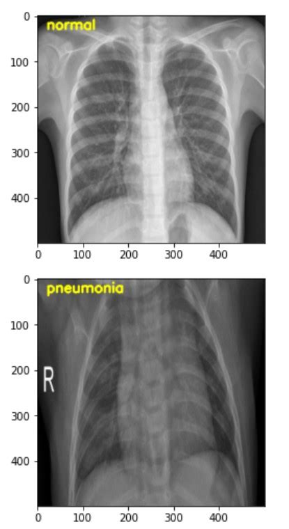 GitHub Pillowknightr Pneumonia Detection Using Chest X Ray