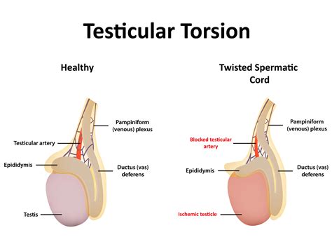 Testicular Torsion Moho