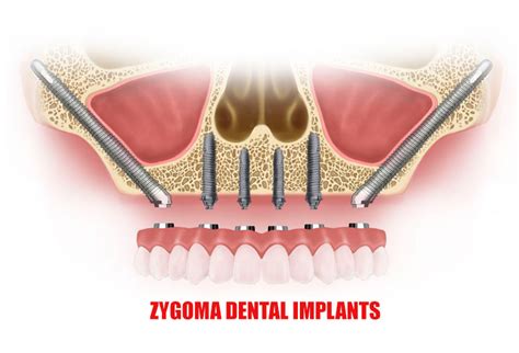What Are Zygomatic Dental Implants Saigon Center Dental Clinic