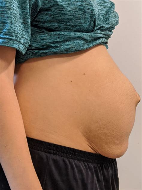 Umbilical Hernia In Women After Pregnancy 330 Umbilical Hernia Stock