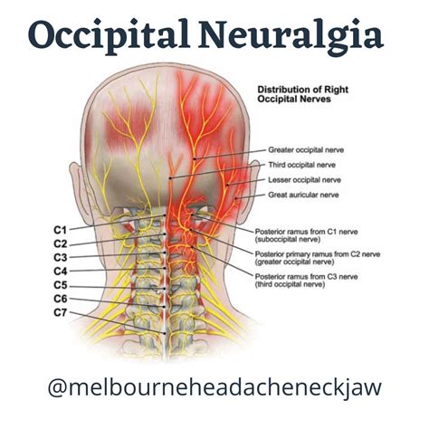 Occipital Neuralgia Diagnostic Criteria Hbun