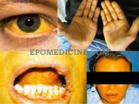 Surgical Jaundice Ppt