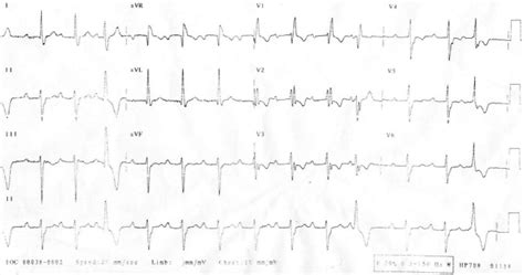 Trifascicular Block Progressing To Complete Av Block On Exercise A Rare Presentation